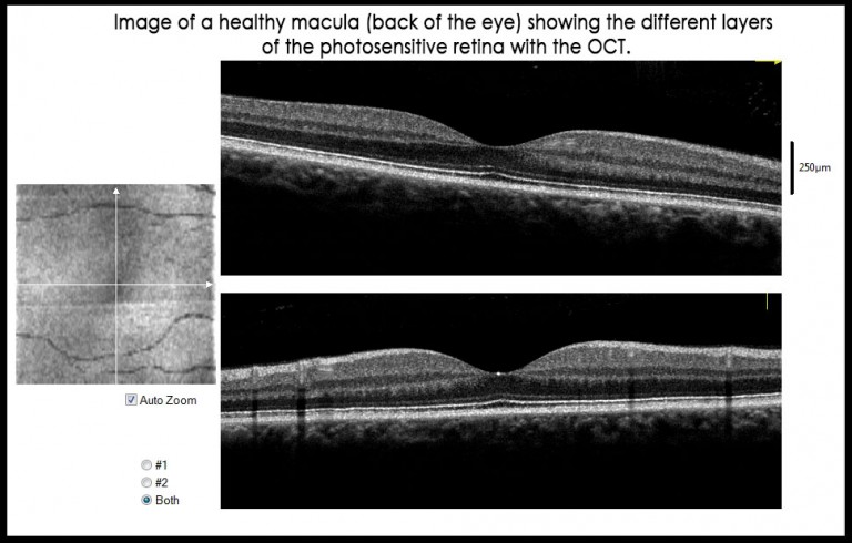 Normal Macula - Charl Laas Optometrists