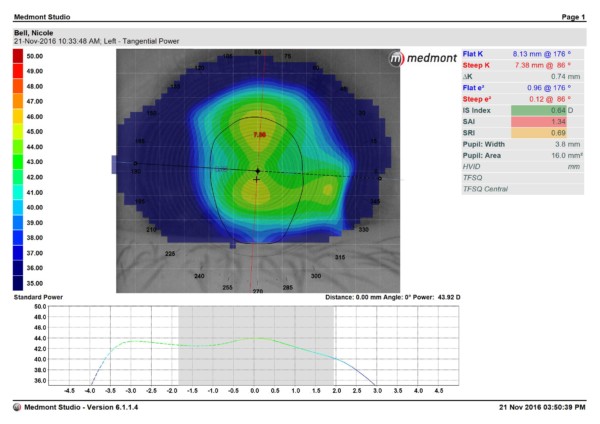 LeftEyeMedmontTopograpy - Charl Laas Optometrists