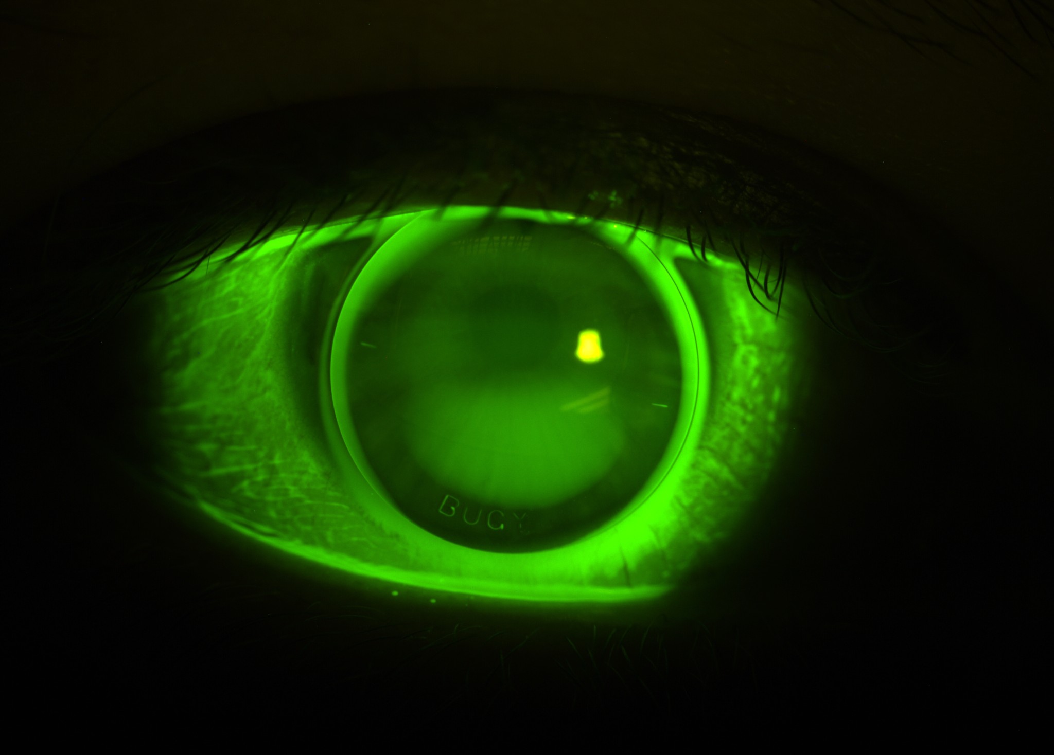 EyeSpace Bespoke Bitoric On Right Eye NAFL Charl Laas Optometrists